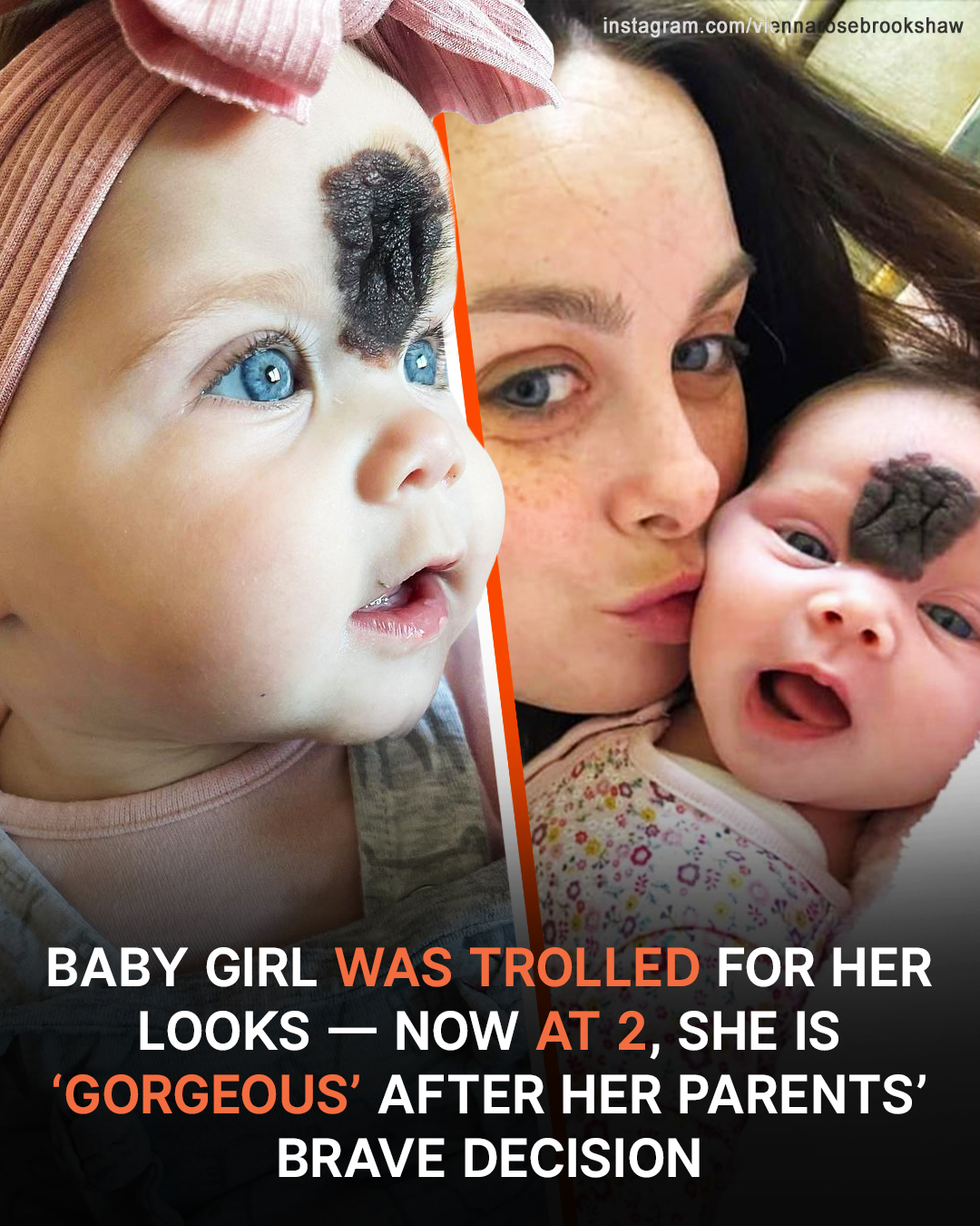 Parents Hid Baby's Face to Shield Her from Stares — Now, at 2, She ...